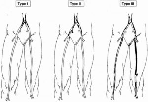Aortoiliac Occlusive Disease – North Texas Vascular Center