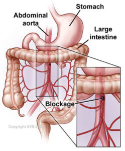 Mesenteric Ischemia – North Texas Vascular Center